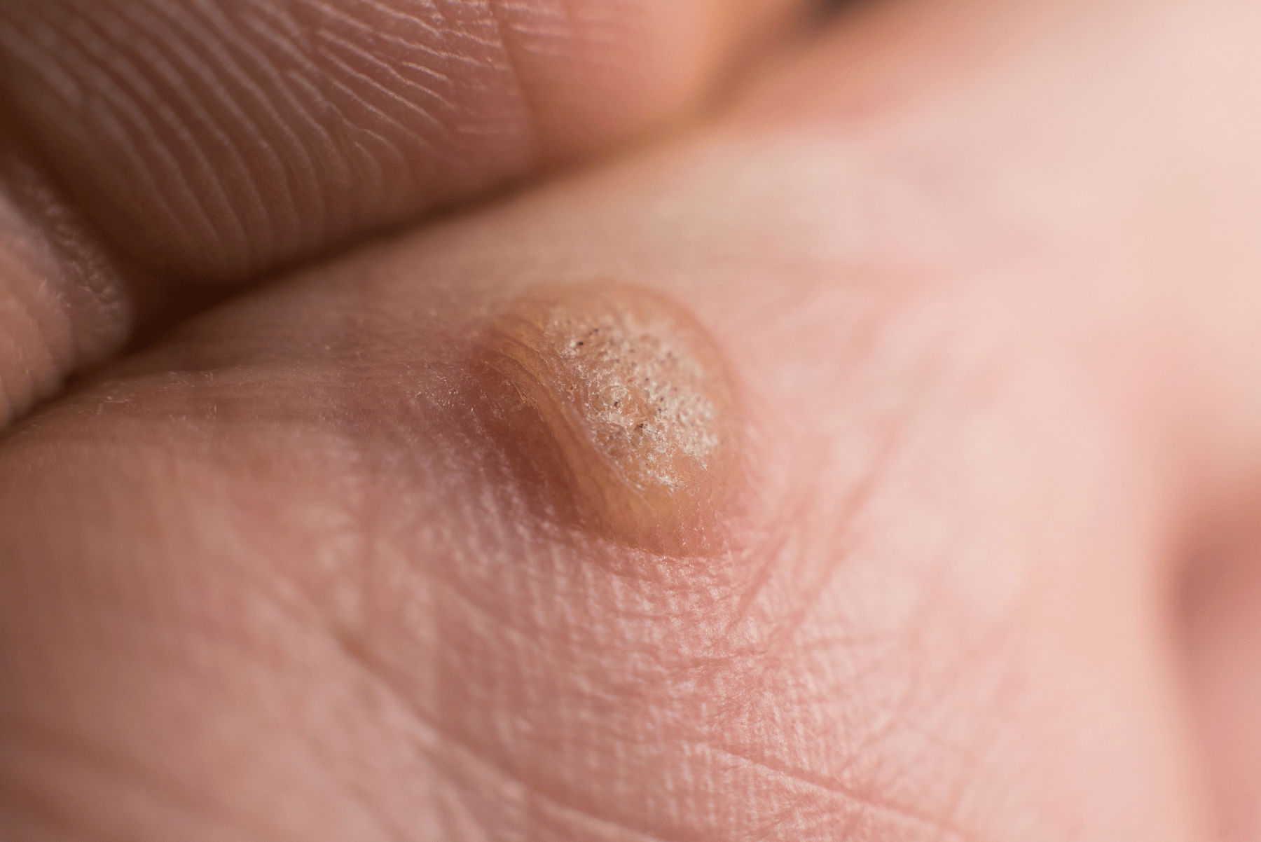 Warts - Cathedral Dermatology