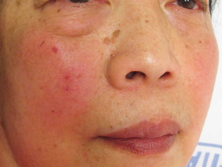 Rosacea - Cathedral Dermatology