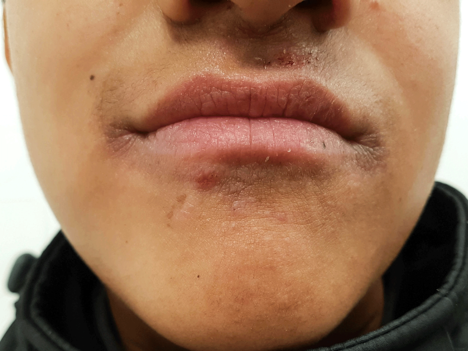 Blistering Disorders - Cathedral Dermatology