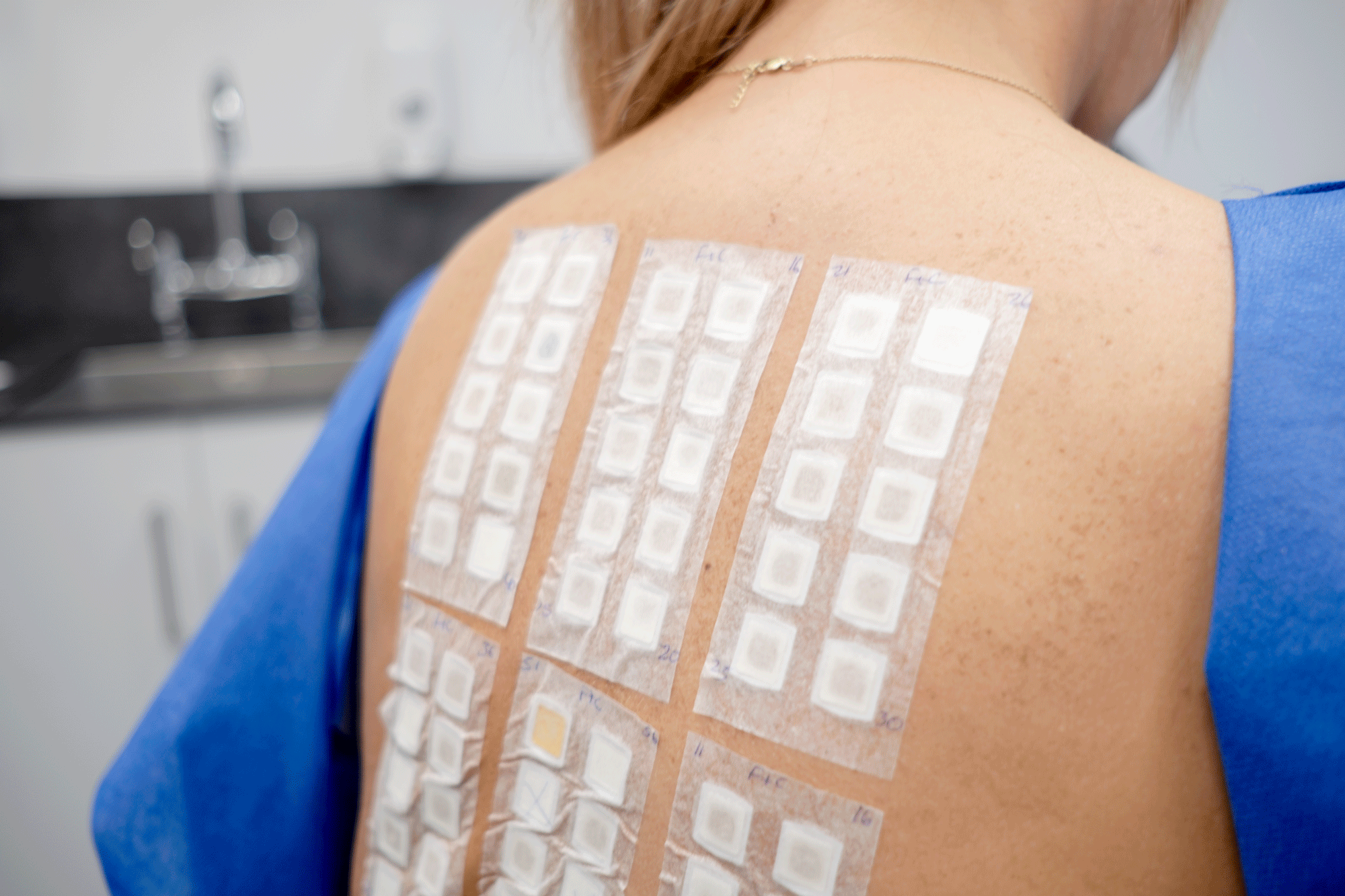 Patch Testing - Cathedral Dermatology