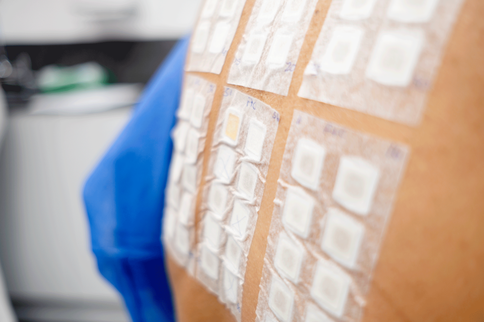 Patch Testing - Cathedral Dermatology