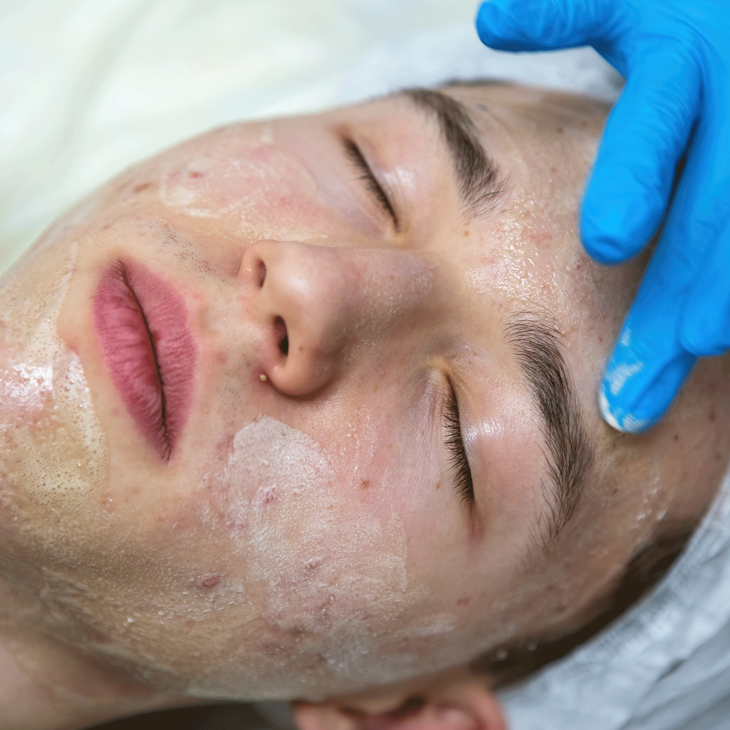 Acne - Cathedral Dermatology