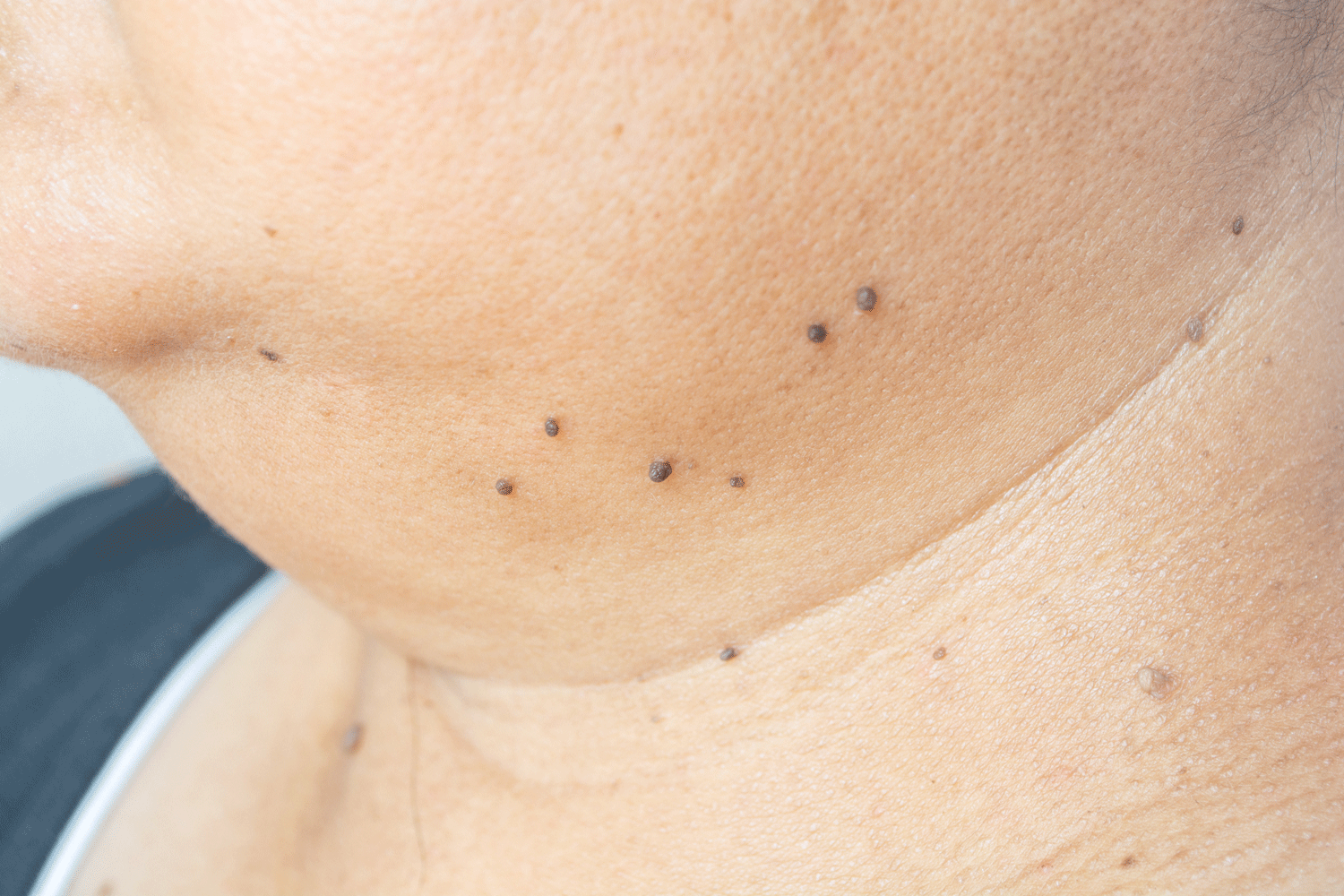 Skin Tags - Cathedral Dermatology