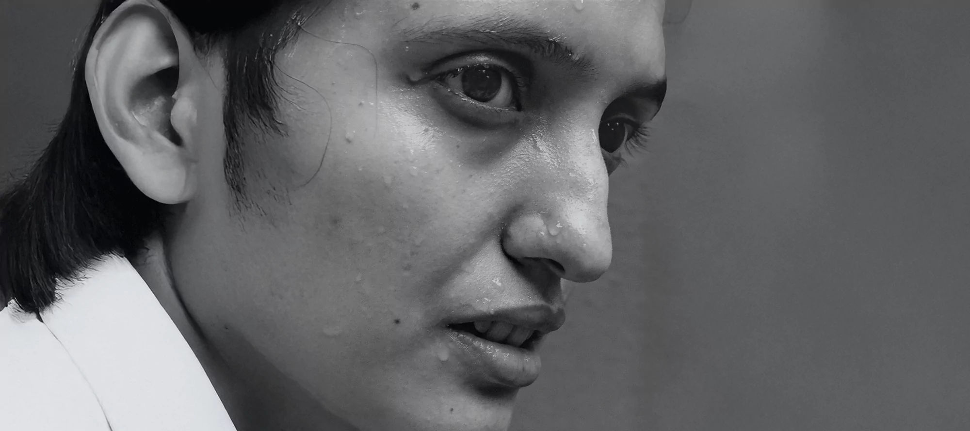 Hyperhidrosis (Underarm Botox® Treatment) - Cathedral Dermatology